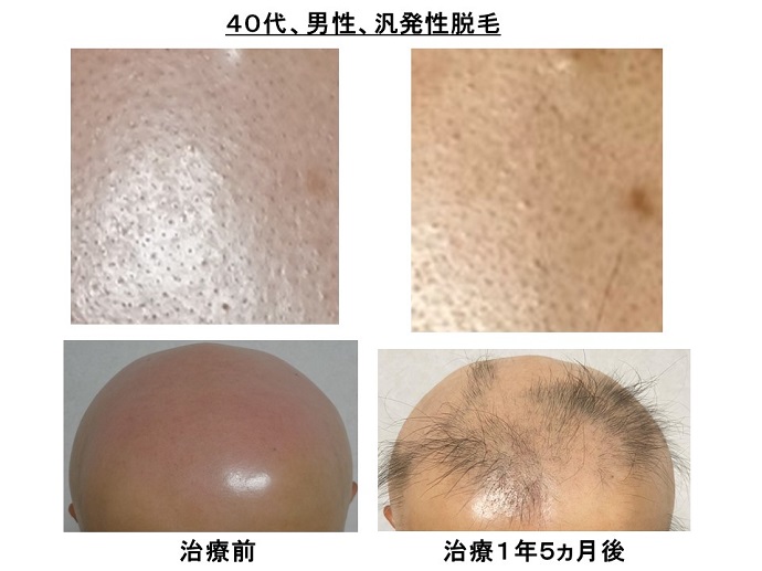 患者様の声；”（初診で）毛根は死んでしまっても、毛は生えるんですか？” 患者様からの声・メディア掲載・クリニックからのお知らせ 名古屋k